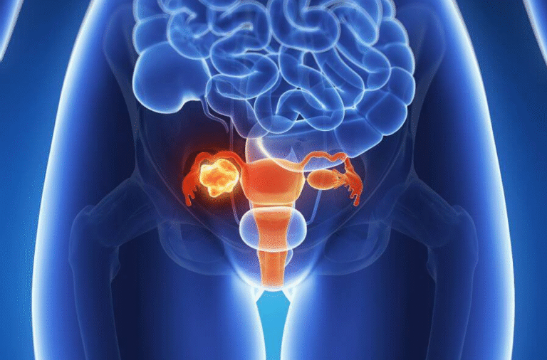 Miomas Uterinos: Qué Son, Causas y Tratamientos Naturales ...